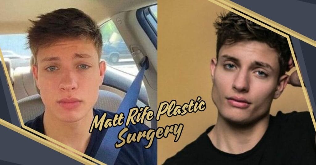 Matt Rife Plastic Surgery: Before and After Look